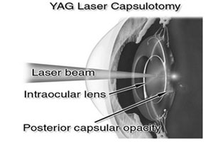 Yag Capsulotomy | U.P. Ophthalmology Associates